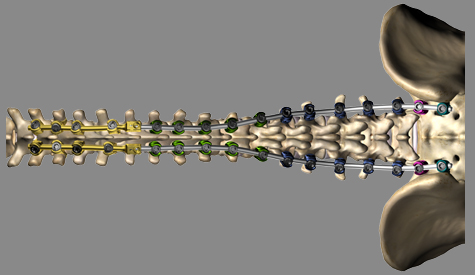 Tiger® Deformity. Spine System - SPINEMarketGroup